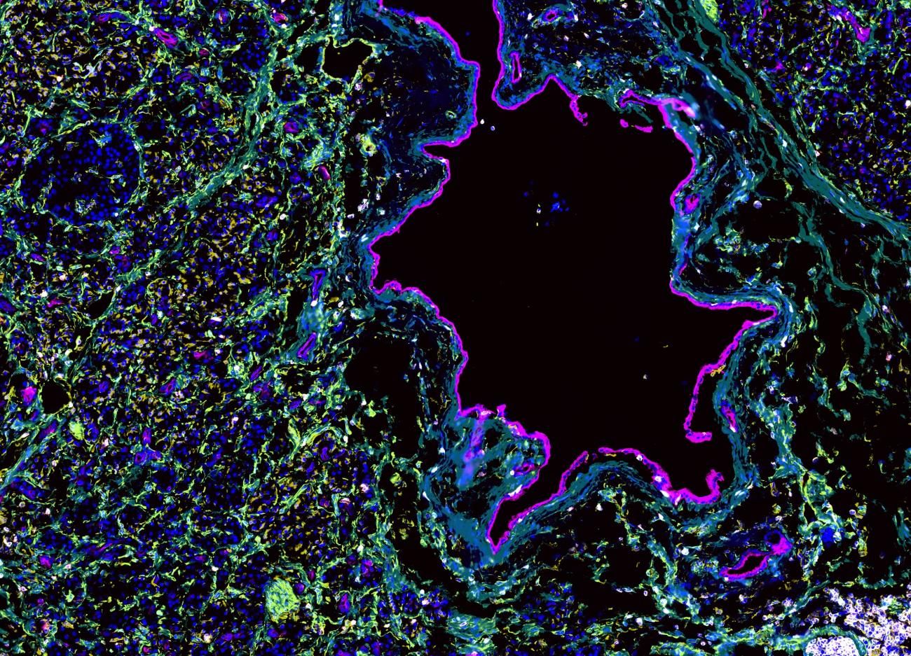 Impact | Cancer Grand Challenges